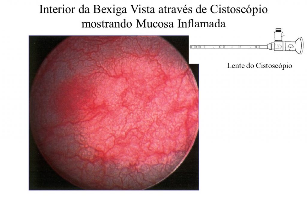 CISTITE INTERSTICIAL: SÍNDROME DA BEXIGA DOLOROSA/ DORES PÉLVICAS